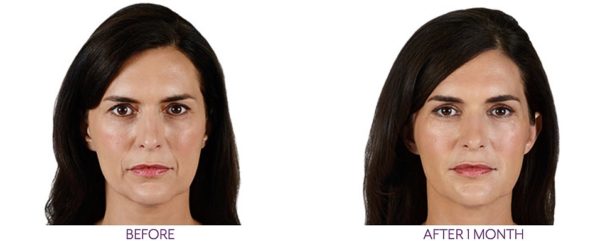 Soft Tissue Fillers | New York City | Manhattan NY